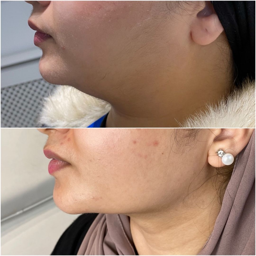 Fat Dissolving Injections London | SAS Aesthetics