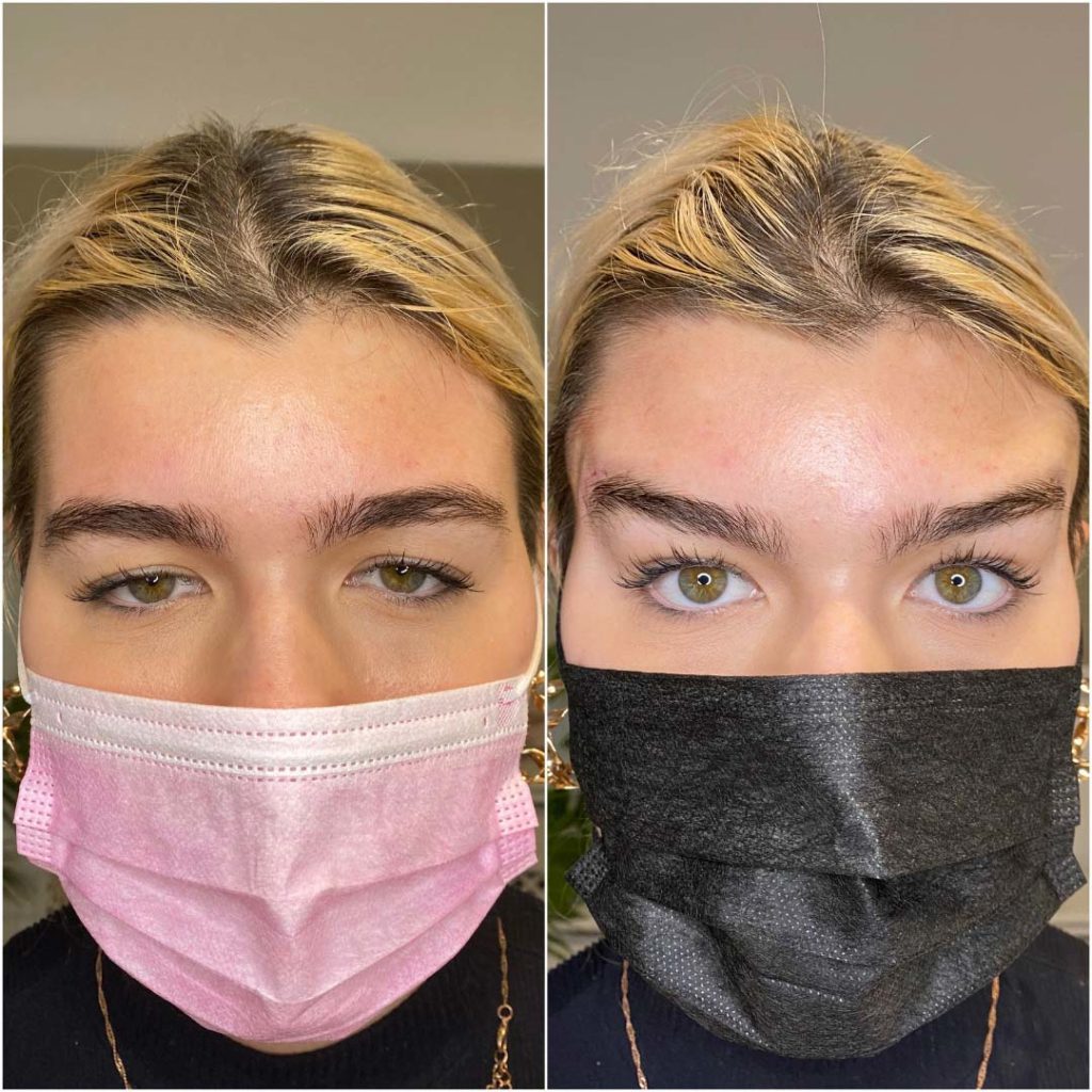 Fox Eye Thread Lift London | SAS Aesthetics