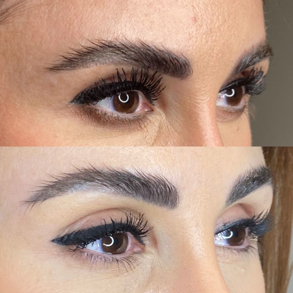 Fox Eye Thread Lifts in Chelsea - SAS Aesthetics