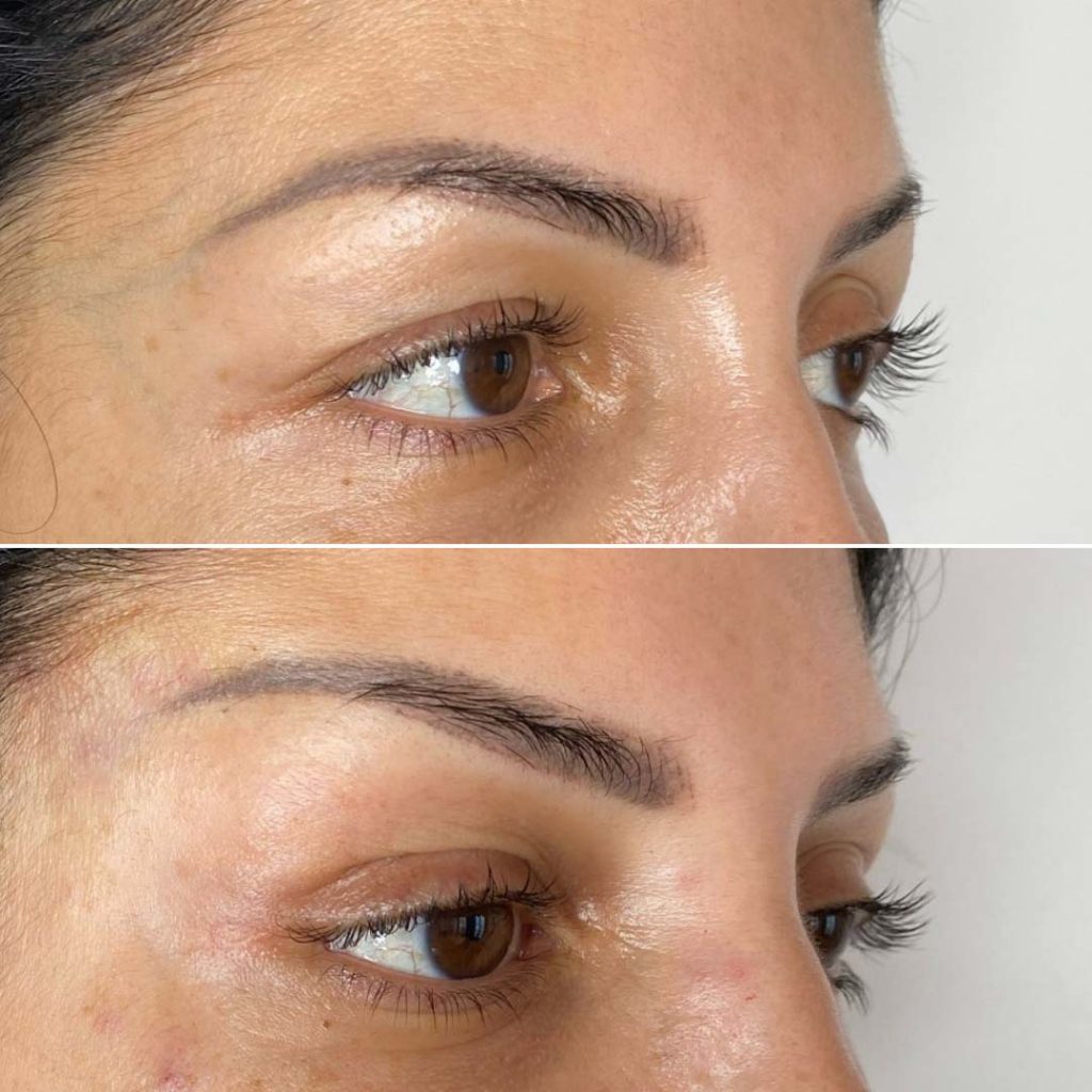Fox Eye Thread Lift London | SAS Aesthetics