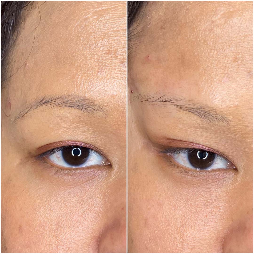 Fox Eye Thread Lift London | SAS Aesthetics