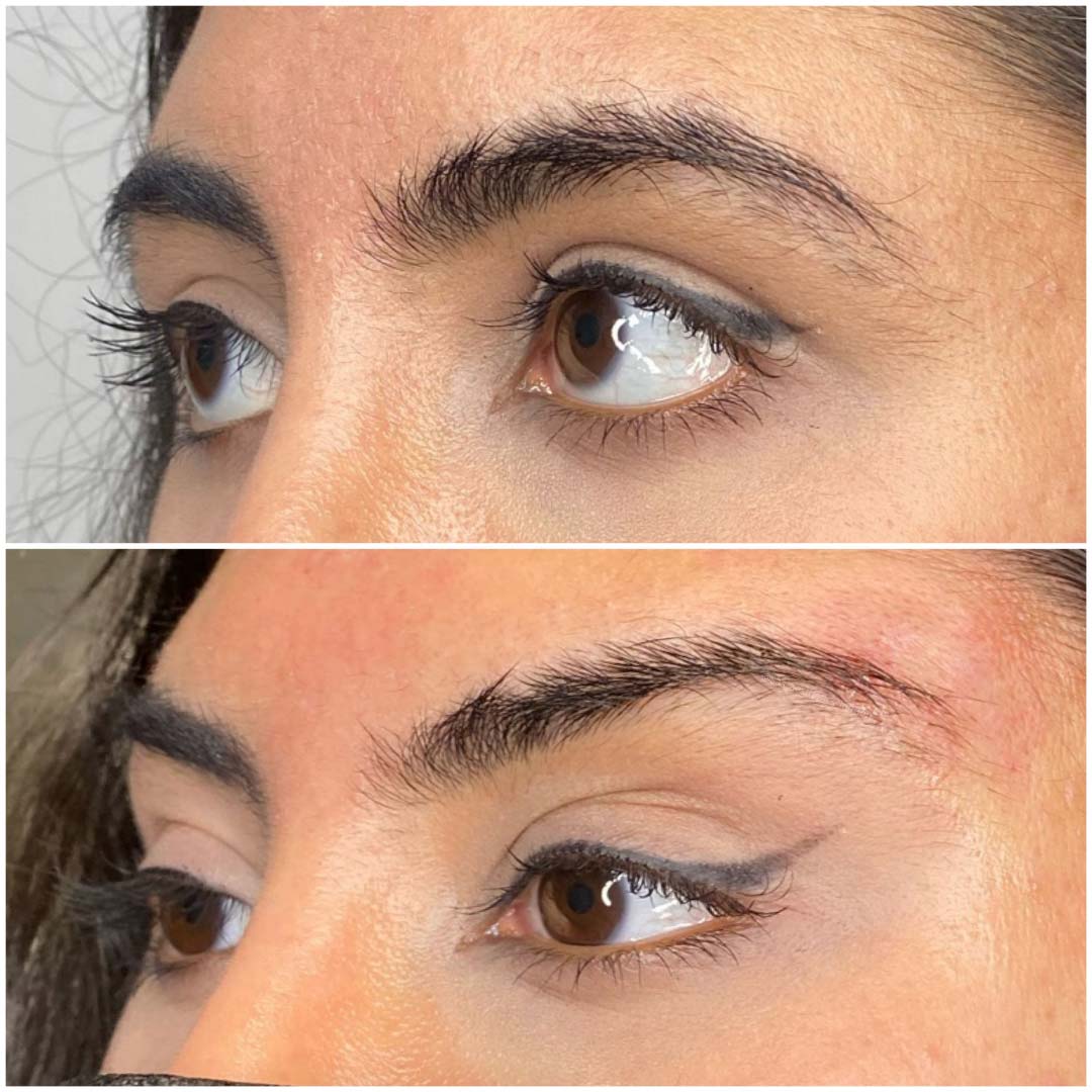 Fox Eye Thread Lift London | SAS Aesthetics