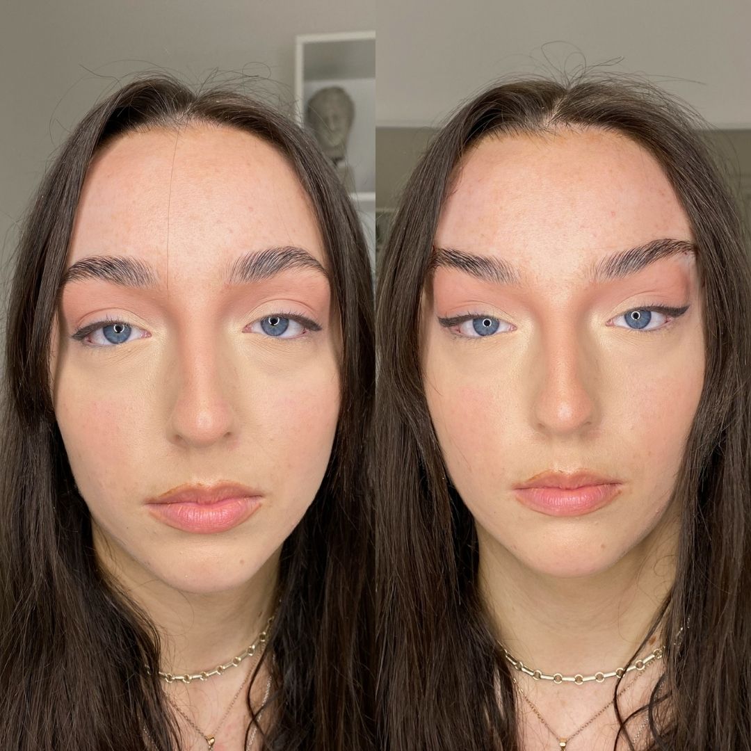 Fox Eye Thread Lift London | SAS Aesthetics