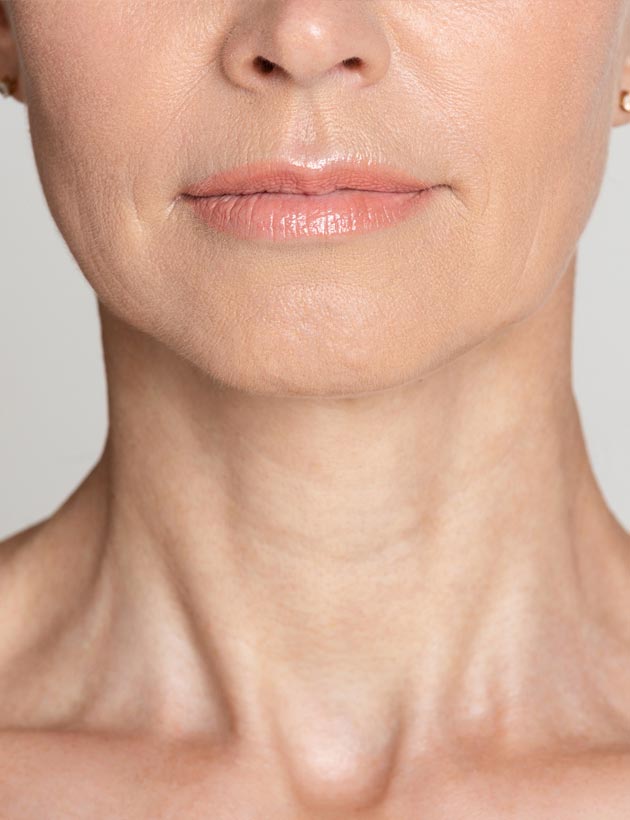 Jowl Treatments & Fillers London | SAS Aesthetics