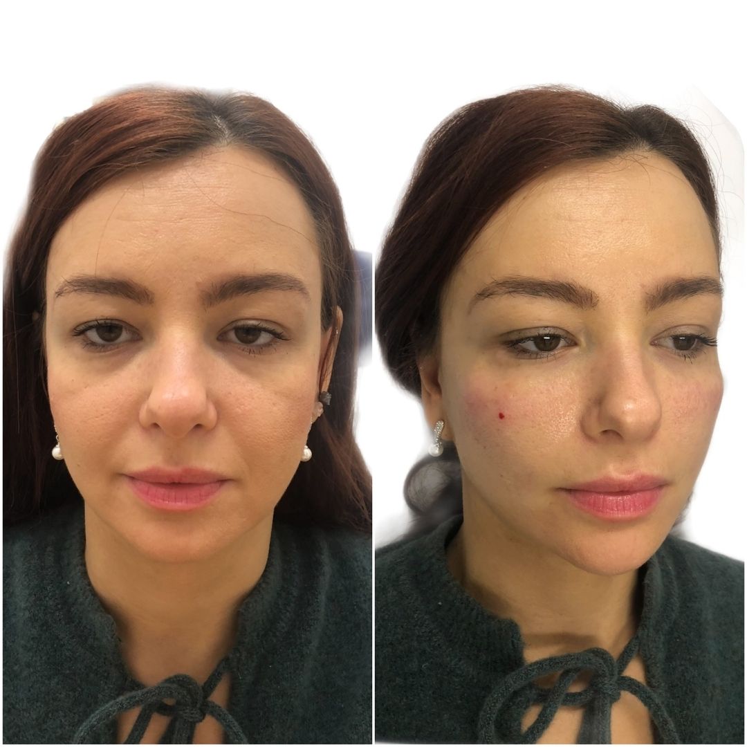 Cheek Volume Injections | SAS Aesthetics