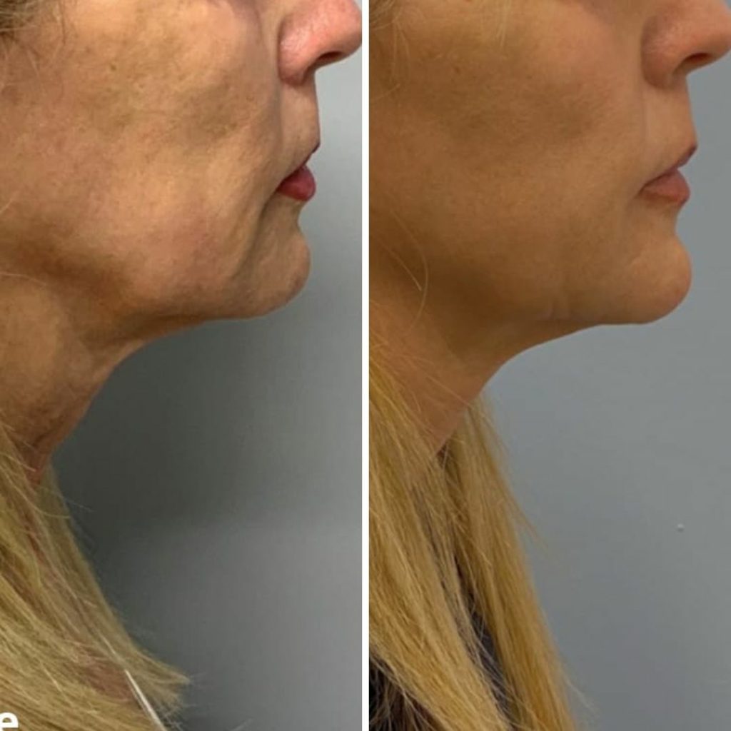 Sofwave Skin Tightening Treatment London | SAS Aesthetics