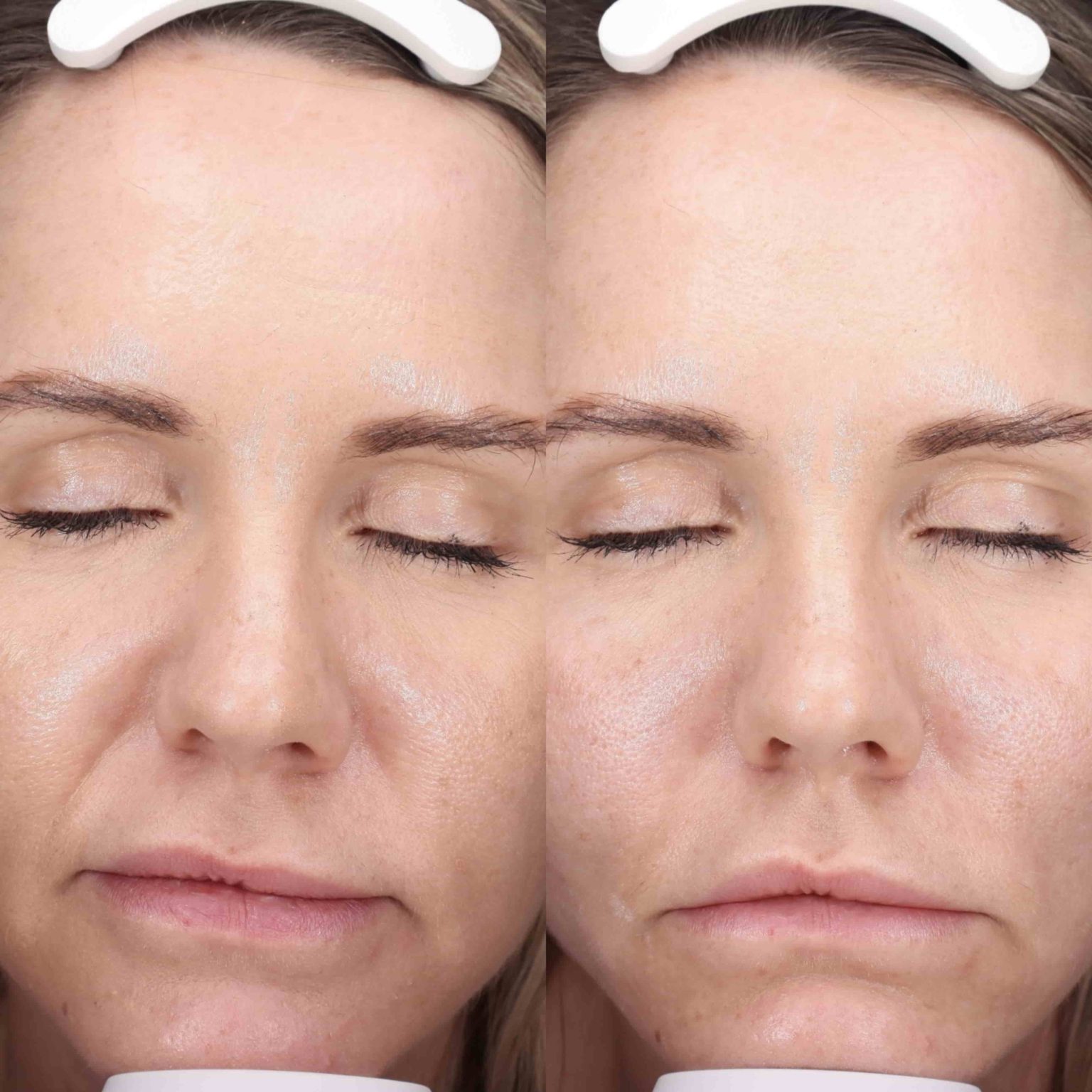 Sofwave Skin Tightening Treatment London | SAS Aesthetics