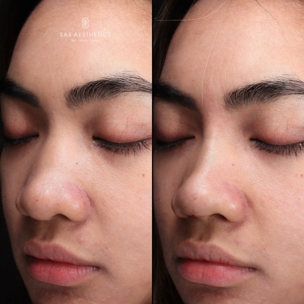 Non-Surgical Rhinoplasty Chelsea | SAS Aesthetics